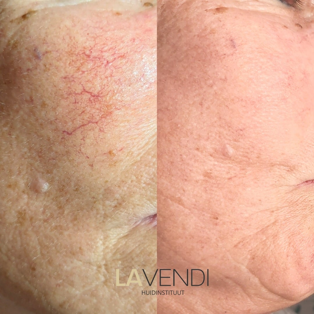 Couperose - Huidinstituut LaVendi